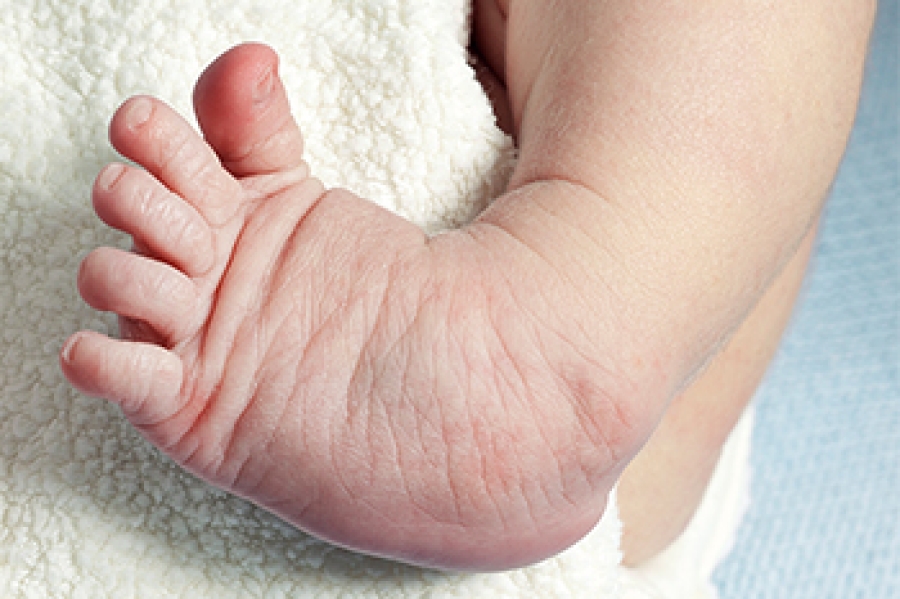 Common Newborn Foot Deformities Explained